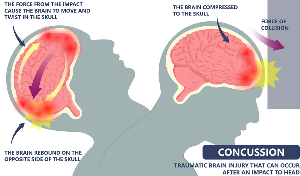 Post Concussion Vision Disorders